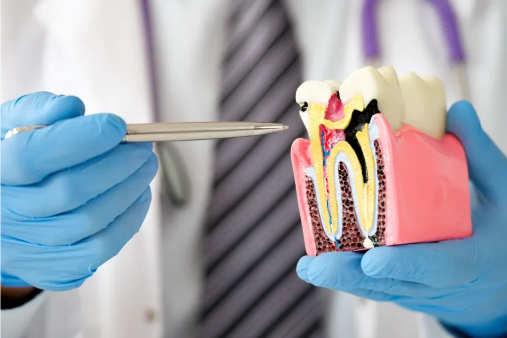 Root Canal Therapy Modesto | Pearl Dental
